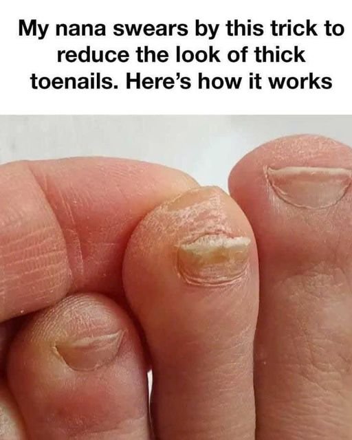 How to Transform Thick Toenails into Healthy, Beautiful Nails